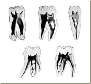 Austin Center for Endodontics, PLLC: Root Canal Anatomy & Complexity